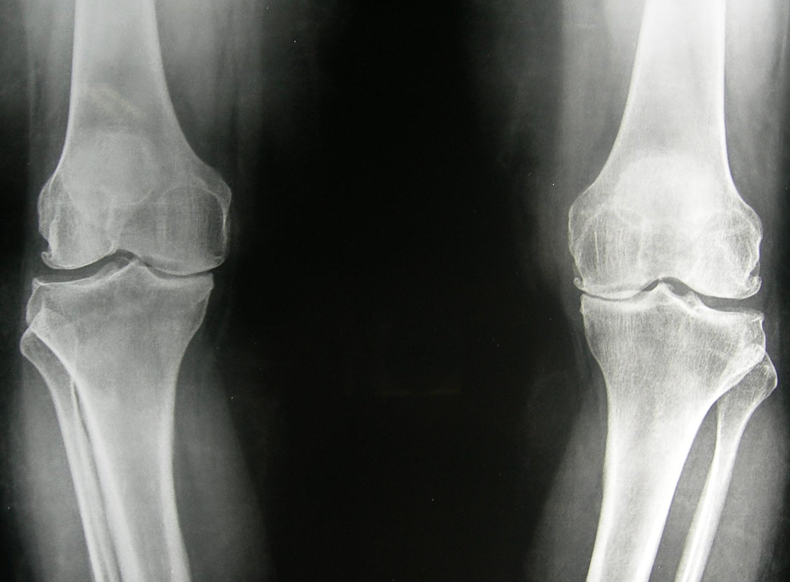 U wilt nog geen nieuwe knie maar wel van de klachten af! Wat kunnen wij ...